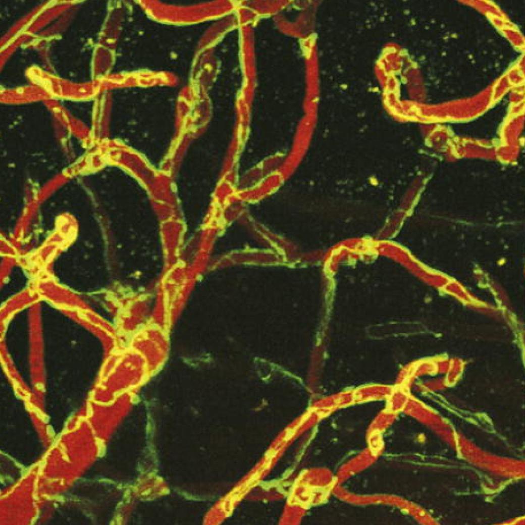 Stroke | Columbia Neurology