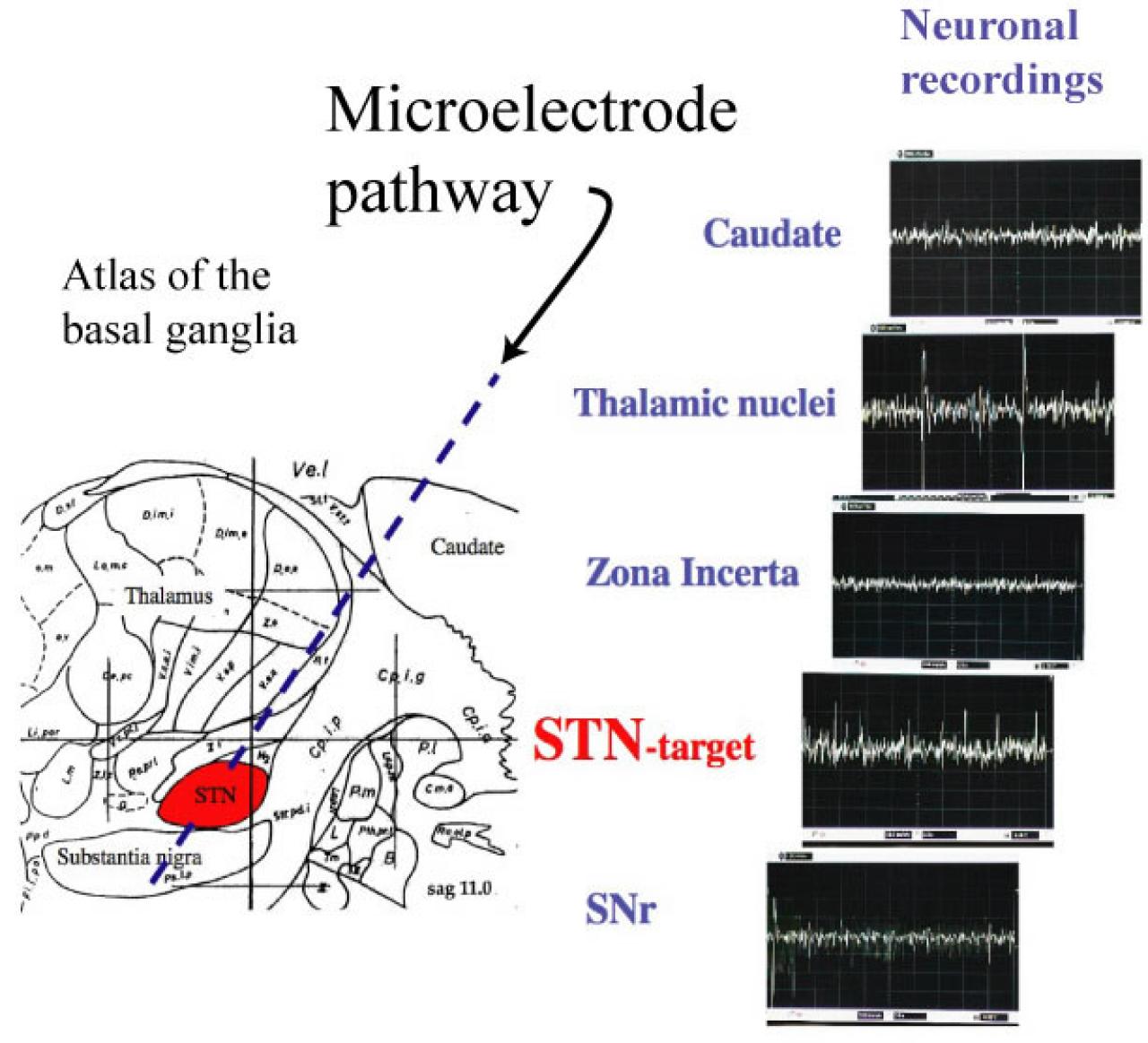 Movement Disorder Surgery: Neurophysiology | Columbia Neurology