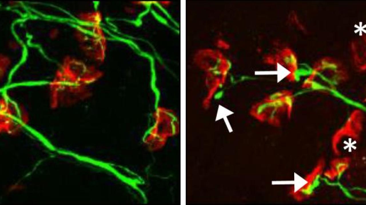 New Insights into the Origins of Spinal Muscular Atrophy | Columbia ...