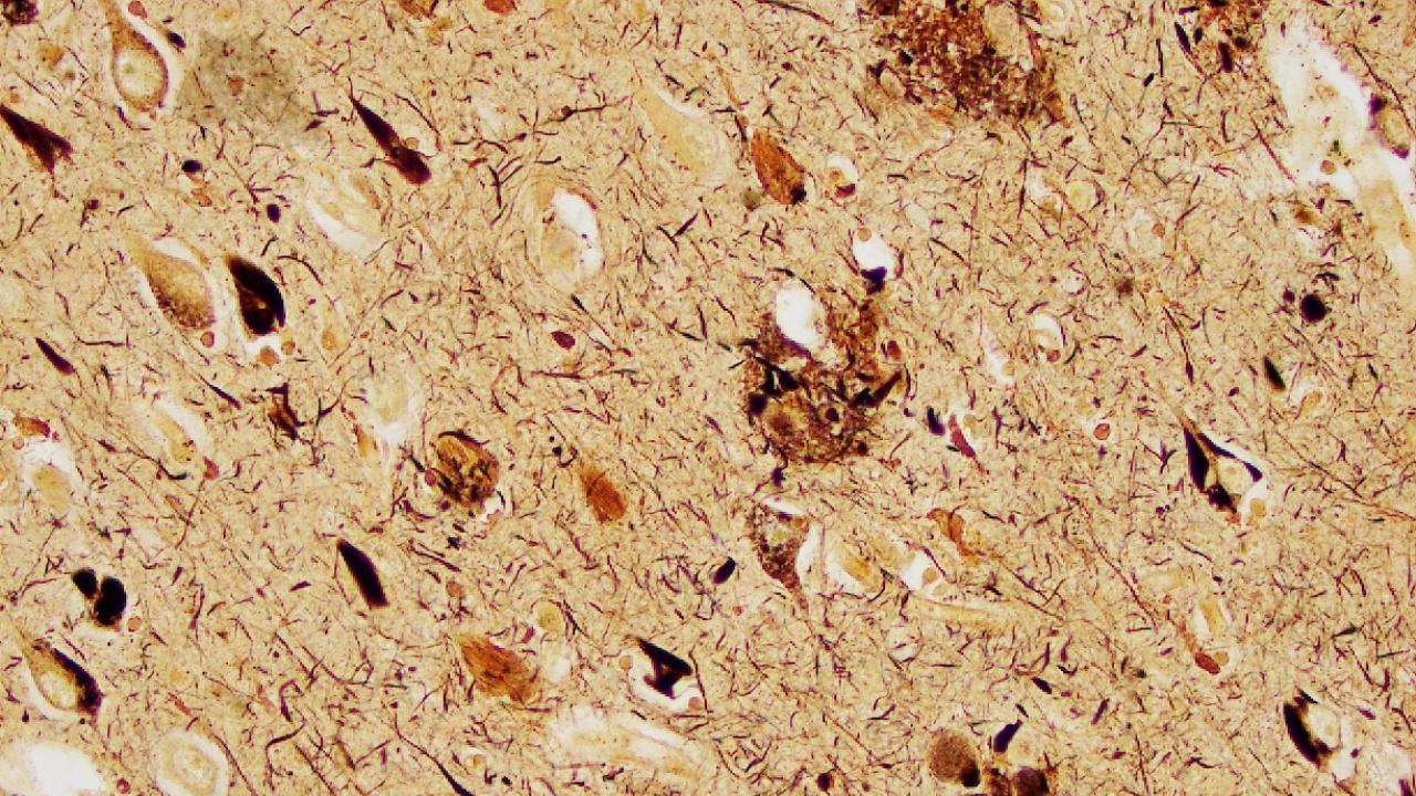 Alzheimer's Neuropathology Core | Columbia Neurology