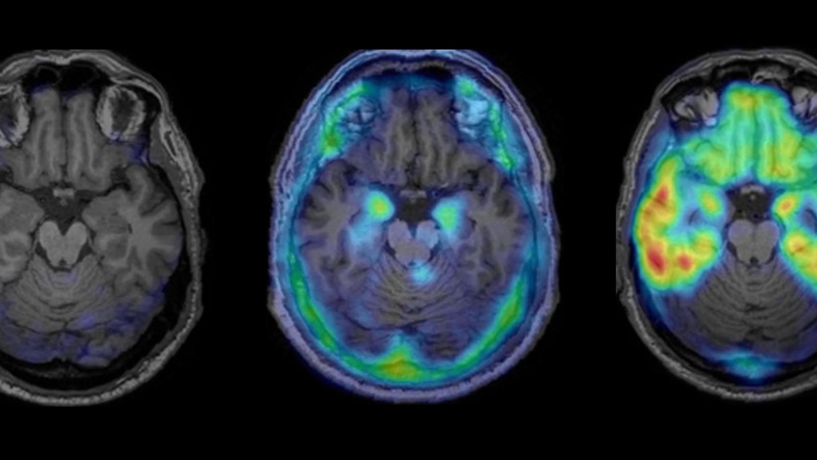 Alzheimer's Disease Research Center (ADRC) | Columbia Neurology