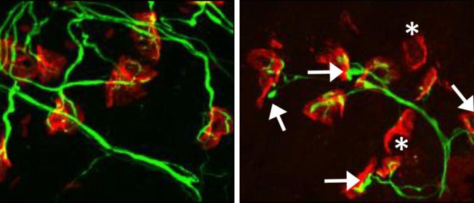 New Insights into the Origins of Spinal Muscular Atrophy | Columbia ...