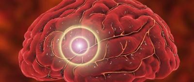 Uncovering Hidden Consciousness in Comatose Brains | Columbia Neurology